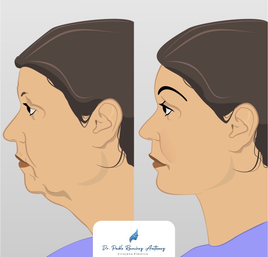 Deep Plane Facelift in Latin America - Dr. PABLO RAMIREZ ANTUNEZ